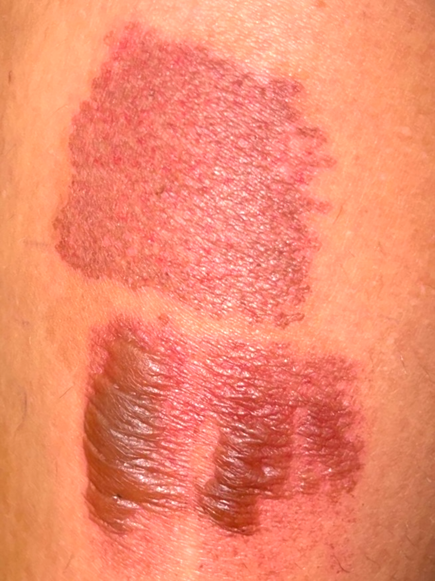 “I’ve burnt my patient!!” With IPL treatments, that is precisely what ...